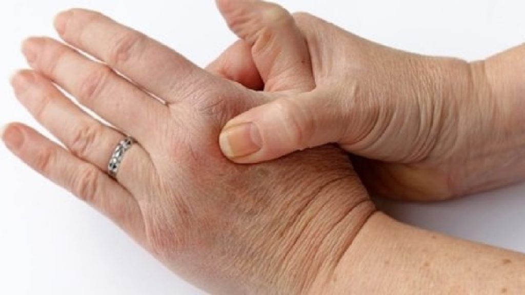 Comment soigner la goutte : comment la reconnaître ? – Inscariaque